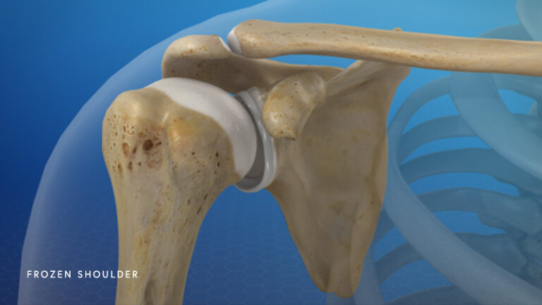 Frozen Shoulder - Center for Orthopedic Specialists