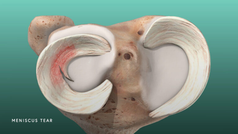 Meniscus Tear - Center for Orthopedic Specialists